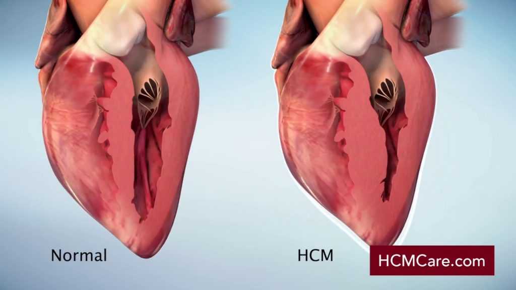Hypertrophic Cardiomyopathy (HCM) Mechanism of Disease Video – Video