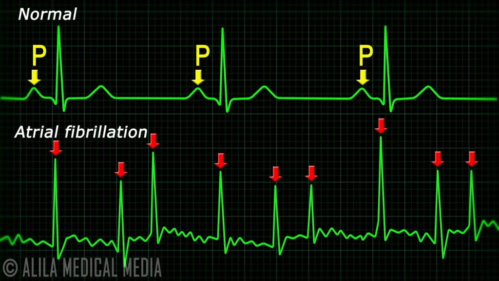 Atrial Fibrillation Anatomy, ECG and Stroke, Animation. – Video